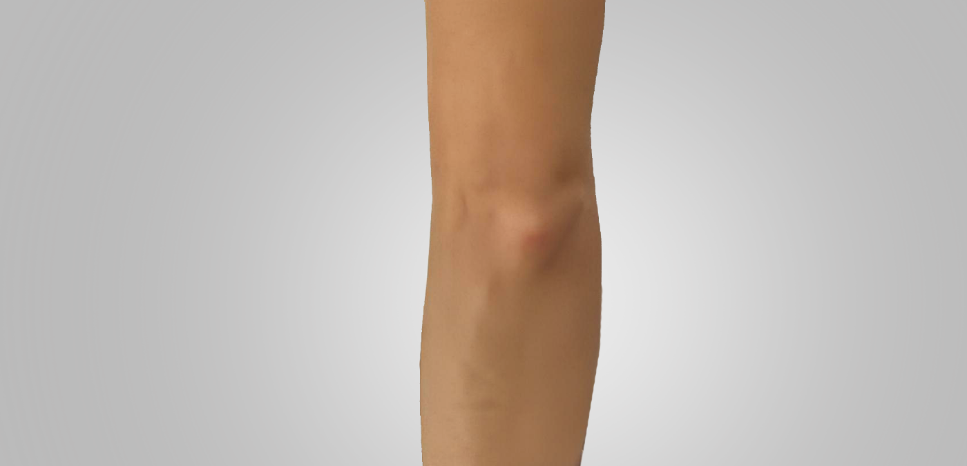 Hyaluronic acid (HA) body filler injection for contouring without surgery